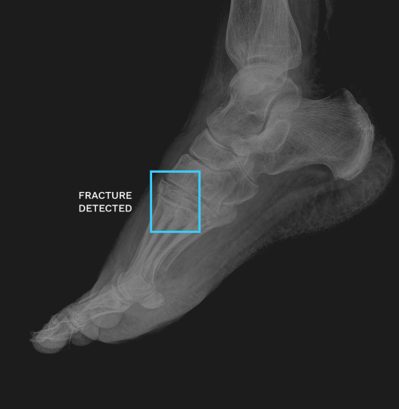 Rbfracturetm Fracture Detection In X Ray Imaging Testdynamics