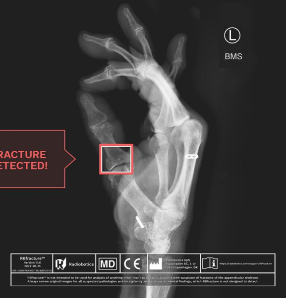 RBfractureTM: Fracture Detection in X-ray Imaging | TestDynamics