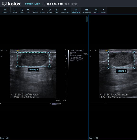 DS Breast: AI-Powered Ultrasound - Breast cancer diagnosis | TestDynamics